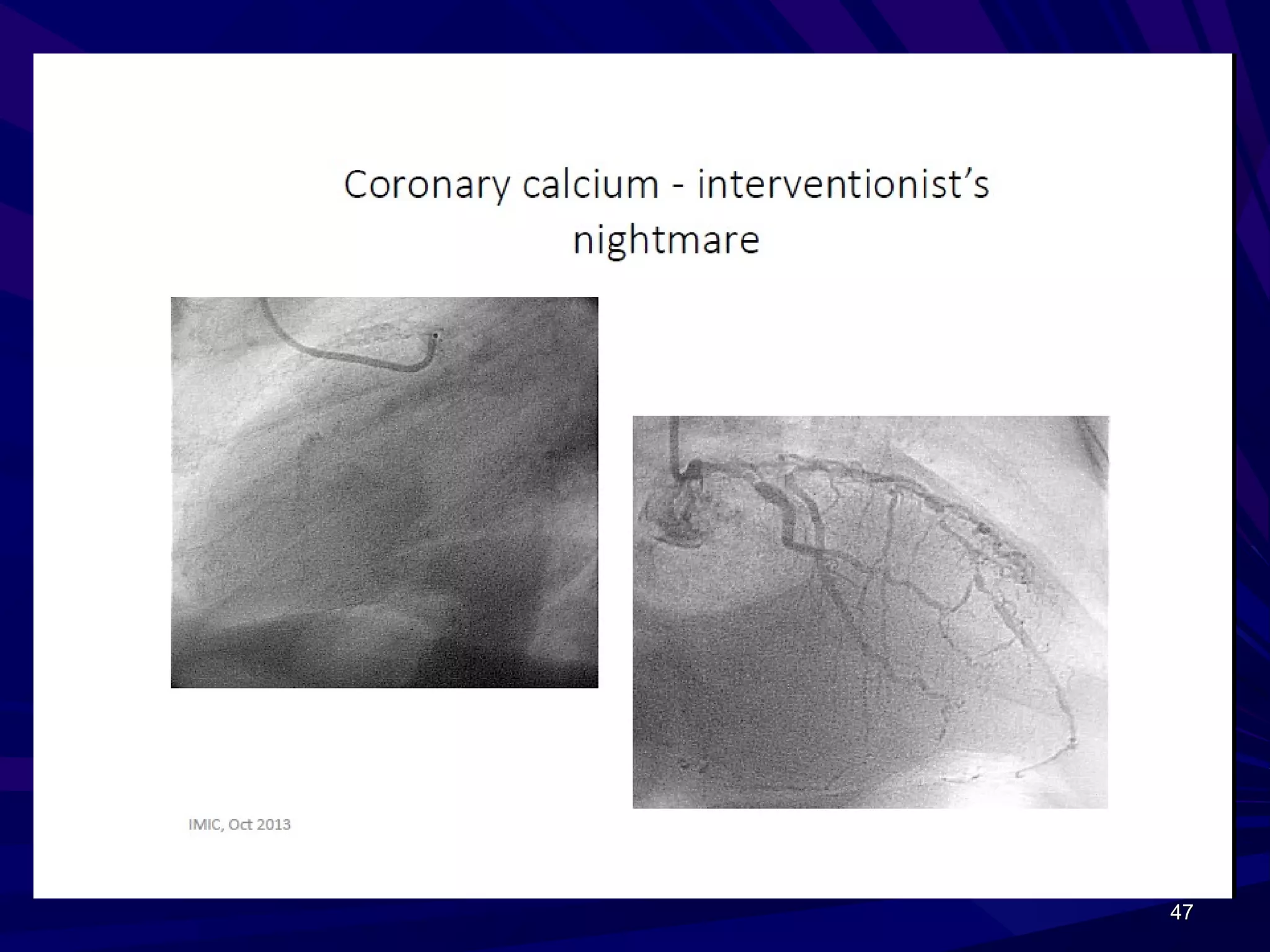 Interpretation of coronary angiogram | PPT