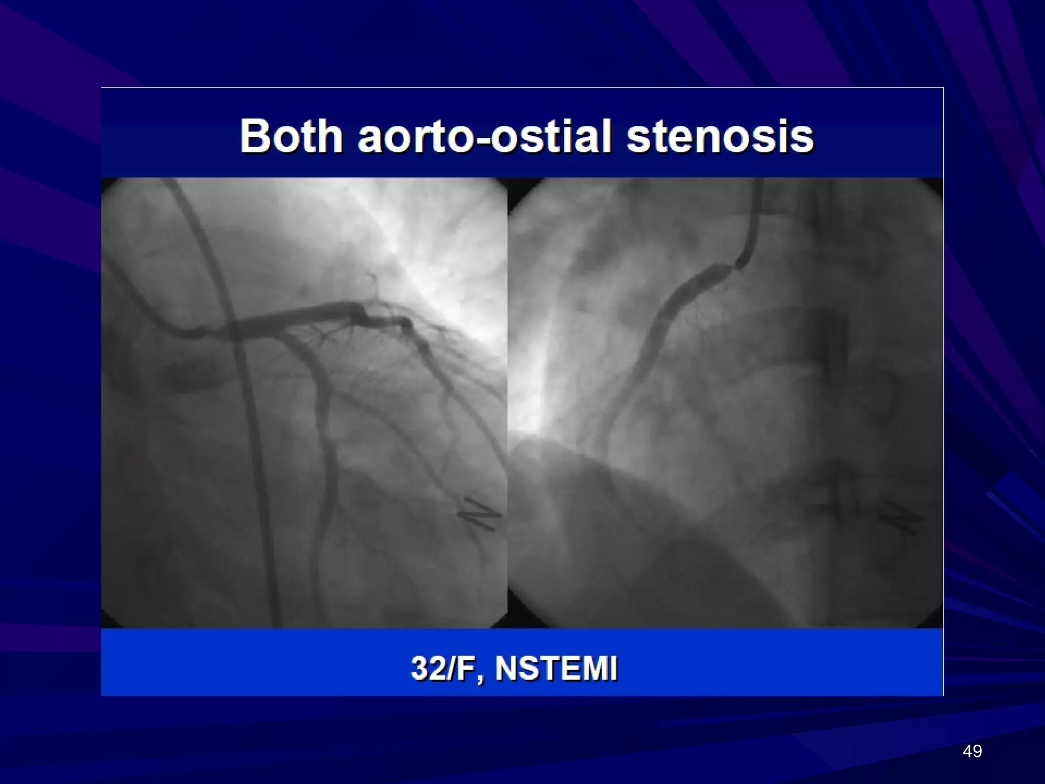 Interpretation of coronary angiogram | PPT
