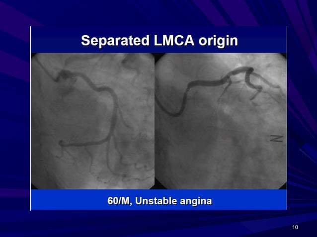 Interpretation of coronary angiogram | PPT