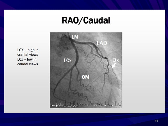 Interpretation of coronary angiogram | PPT