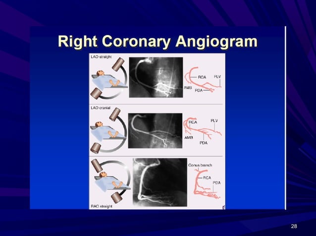 Interpretation of coronary angiogram | PPT