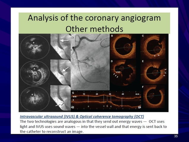 Interpretation of coronary angiogram | PPT