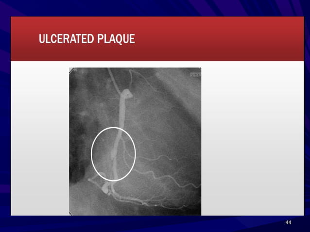 Interpretation of coronary angiogram | PPT