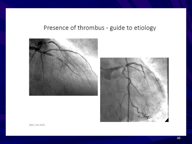 Interpretation of coronary angiogram | PPT