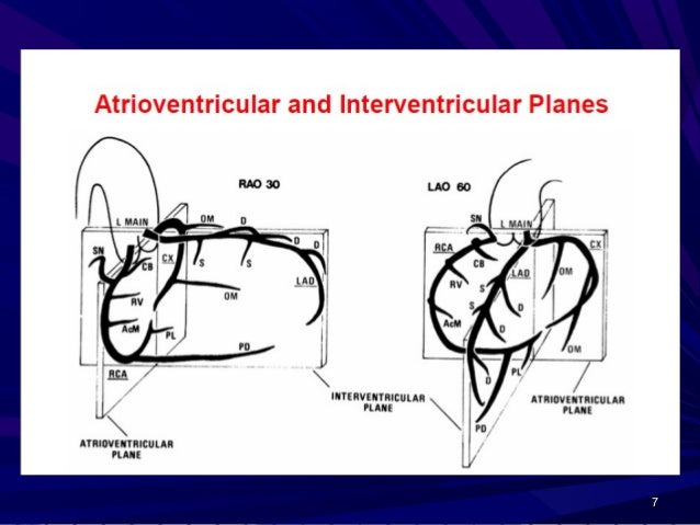 Interpretation of coronary angiogram