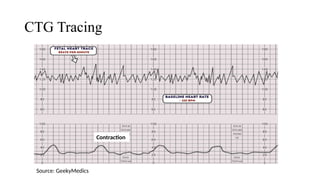 PRINCIPLES OF CARDIOTOCOGRAPHY IN OBSTETRICS AND GYNECOLOGY | PPTX