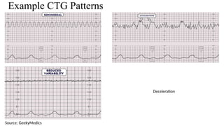 PRINCIPLES OF CARDIOTOCOGRAPHY IN OBSTETRICS AND GYNECOLOGY | PPTX