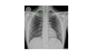 Interpretation of Chest X rays .pptx