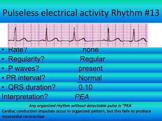 Pulseless Electrical Activity Rhythm Strip