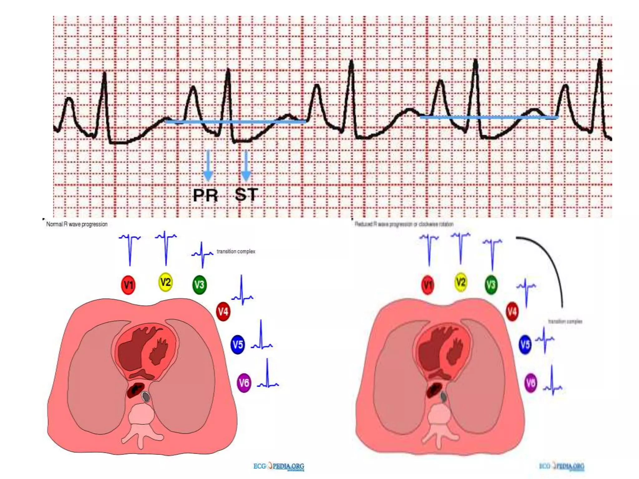 Interpretation of ecg_in_pulmonary_disease | PPTX