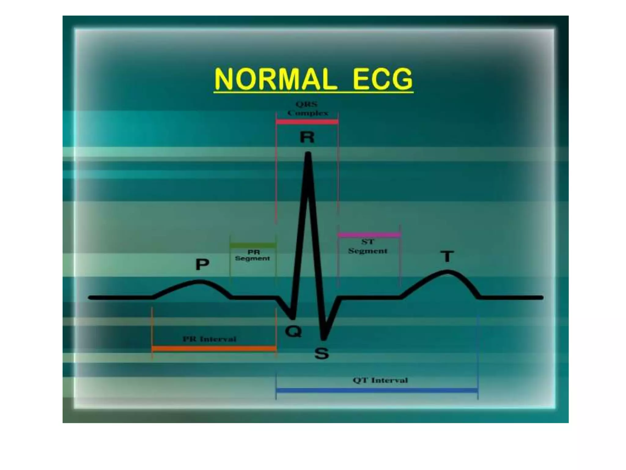 Interpretation of ecg_in_pulmonary_disease | PPTX