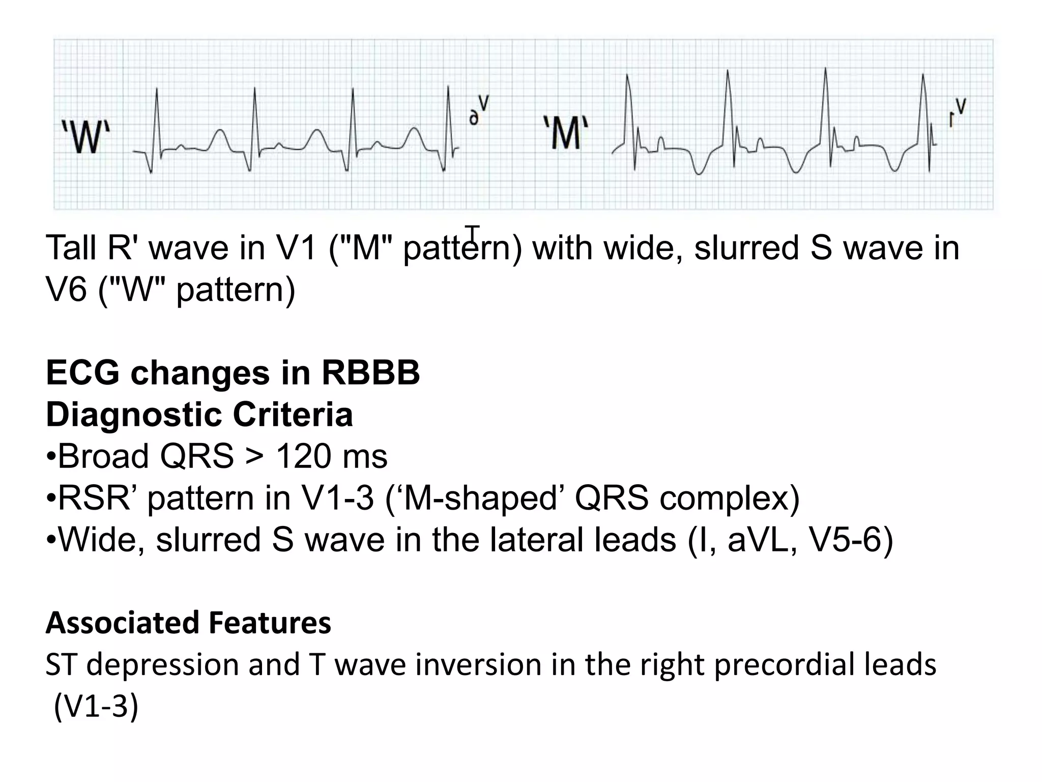Interpretation of ecg_in_pulmonary_disease | PPTX