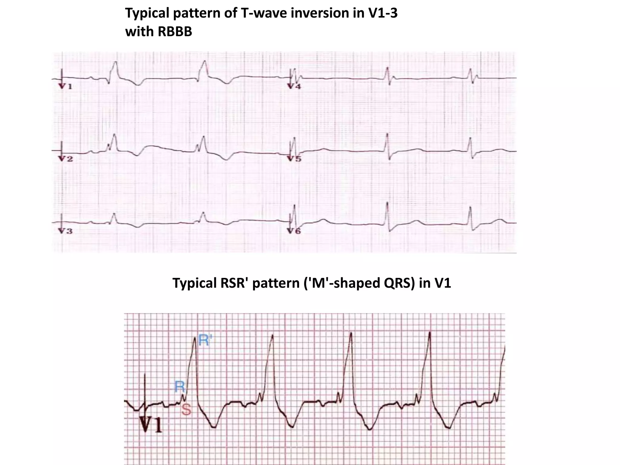 Interpretation of ecg_in_pulmonary_disease | PPTX