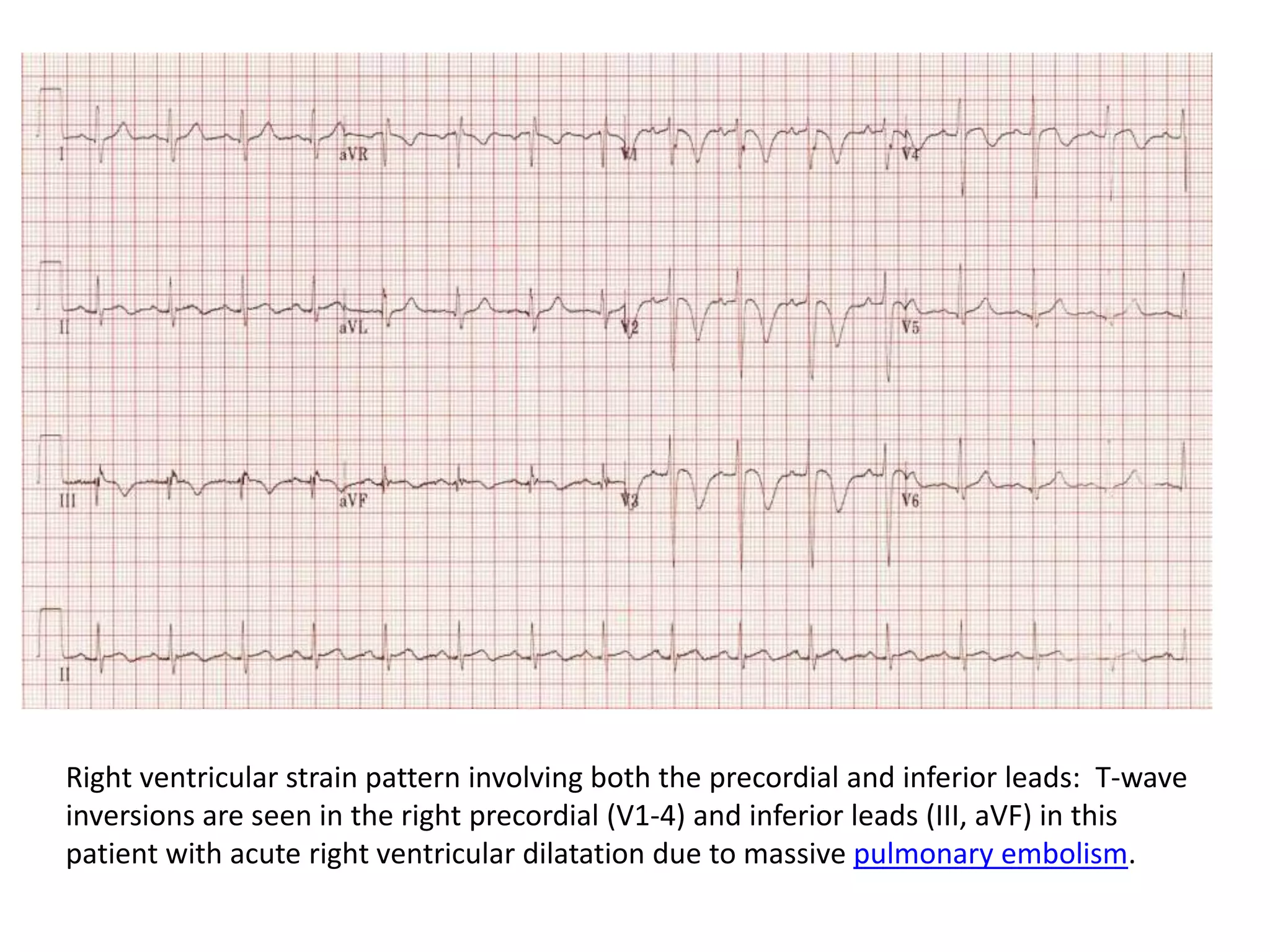 Interpretation of ecg_in_pulmonary_disease | PPTX