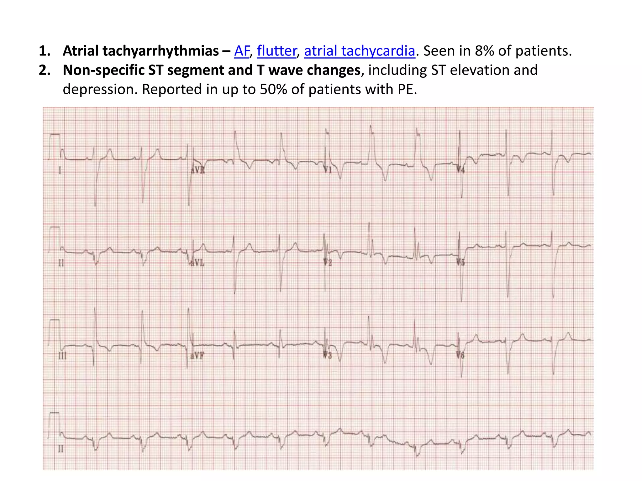 Interpretation of ecg_in_pulmonary_disease | PPTX