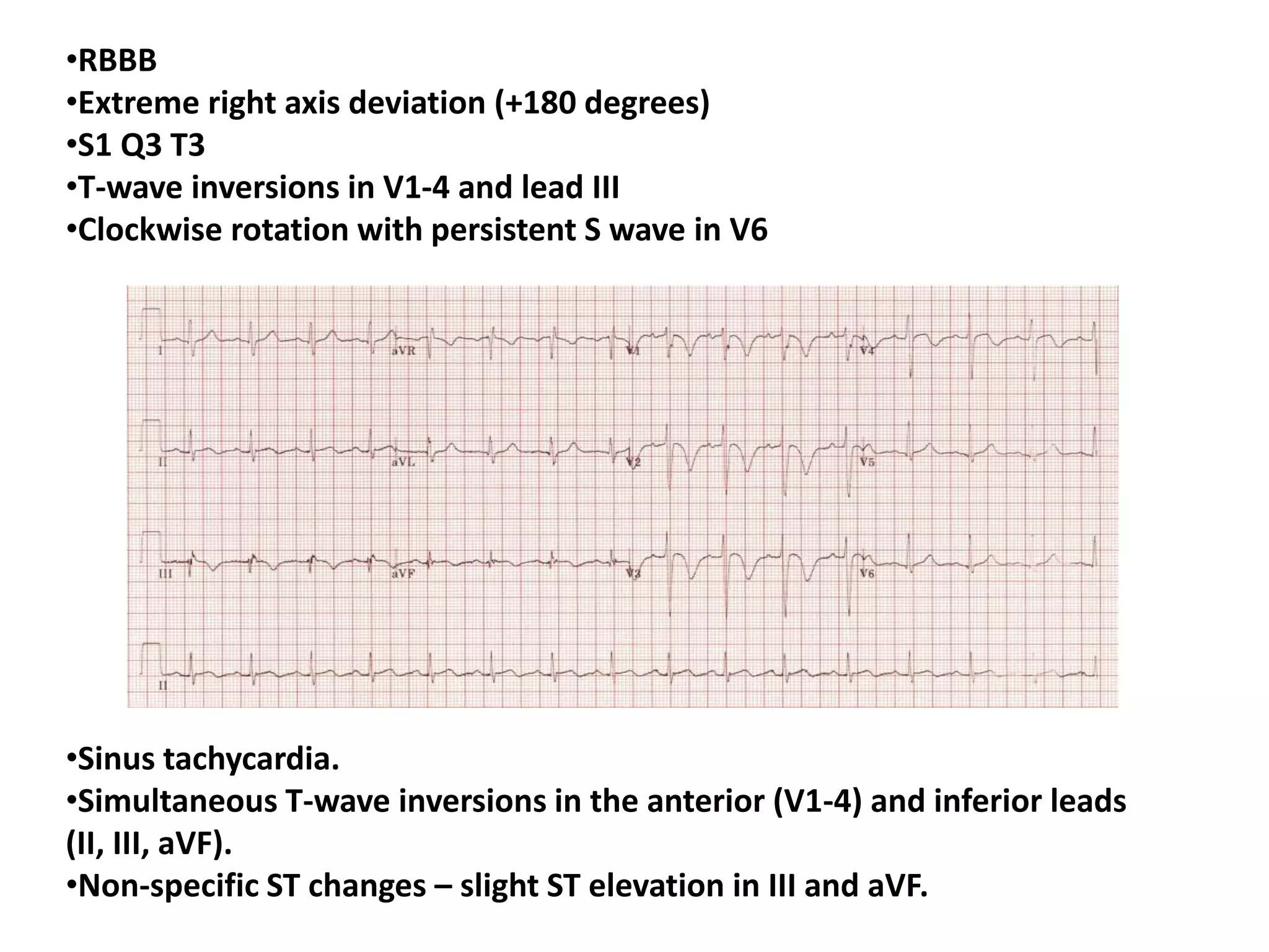 Interpretation of ecg_in_pulmonary_disease | PPTX