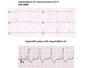 Interpretation of ecg_in_pulmonary_disease | PPTX
