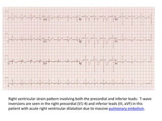 Interpretation of ecg_in_pulmonary_disease | PPTX