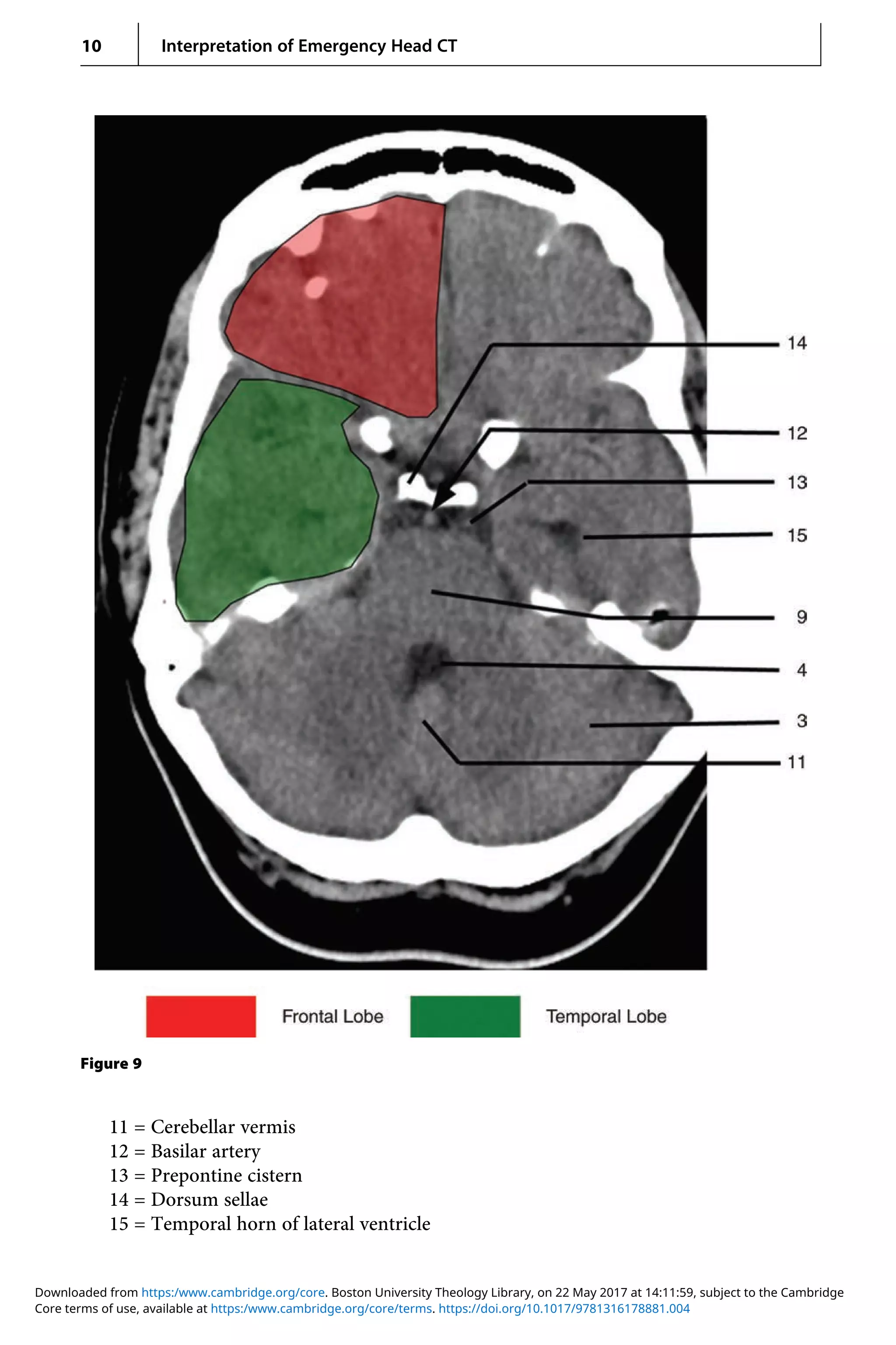 Interpretation of emergency head ct | PDF