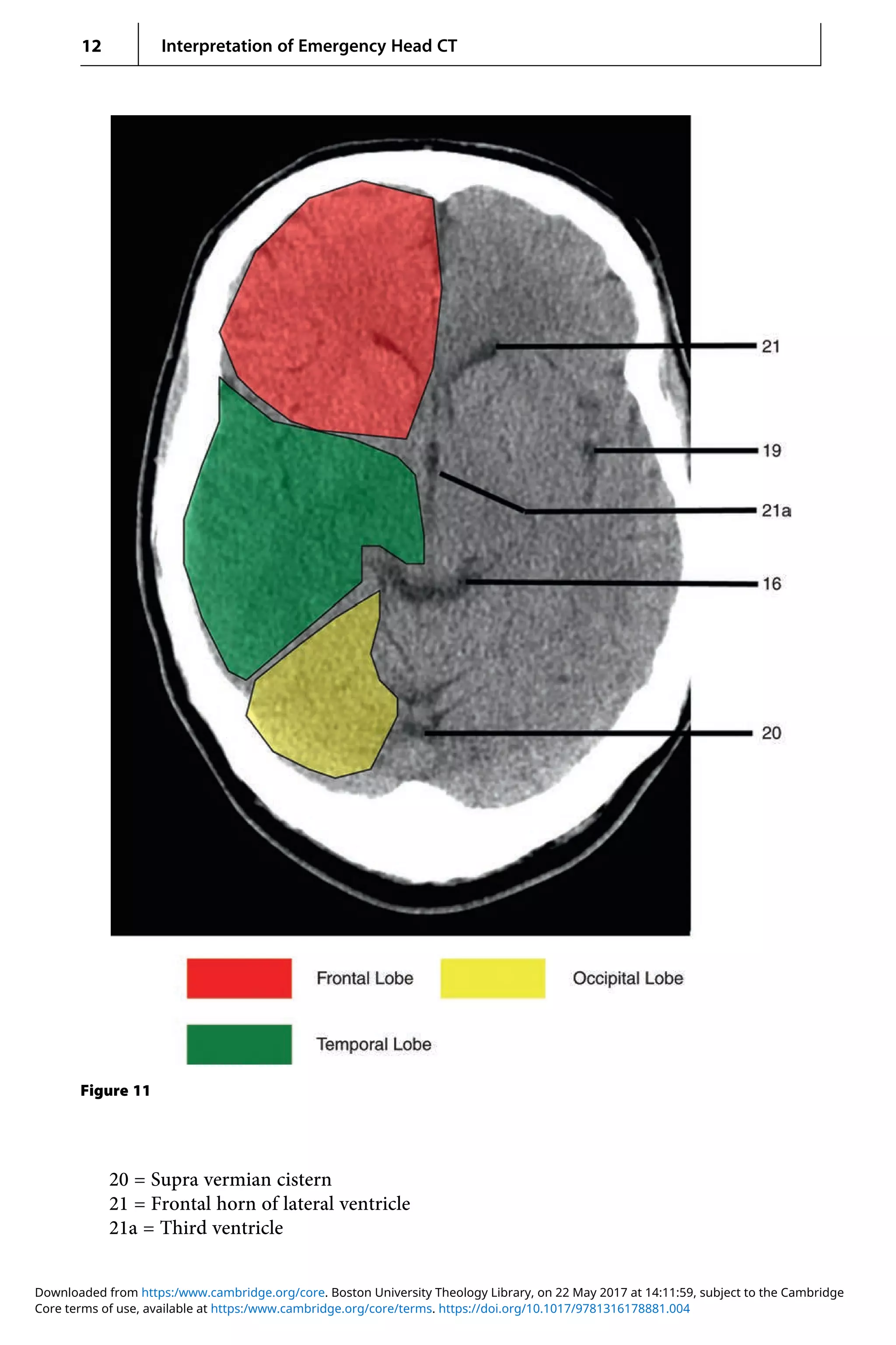 Interpretation of emergency head ct | PDF
