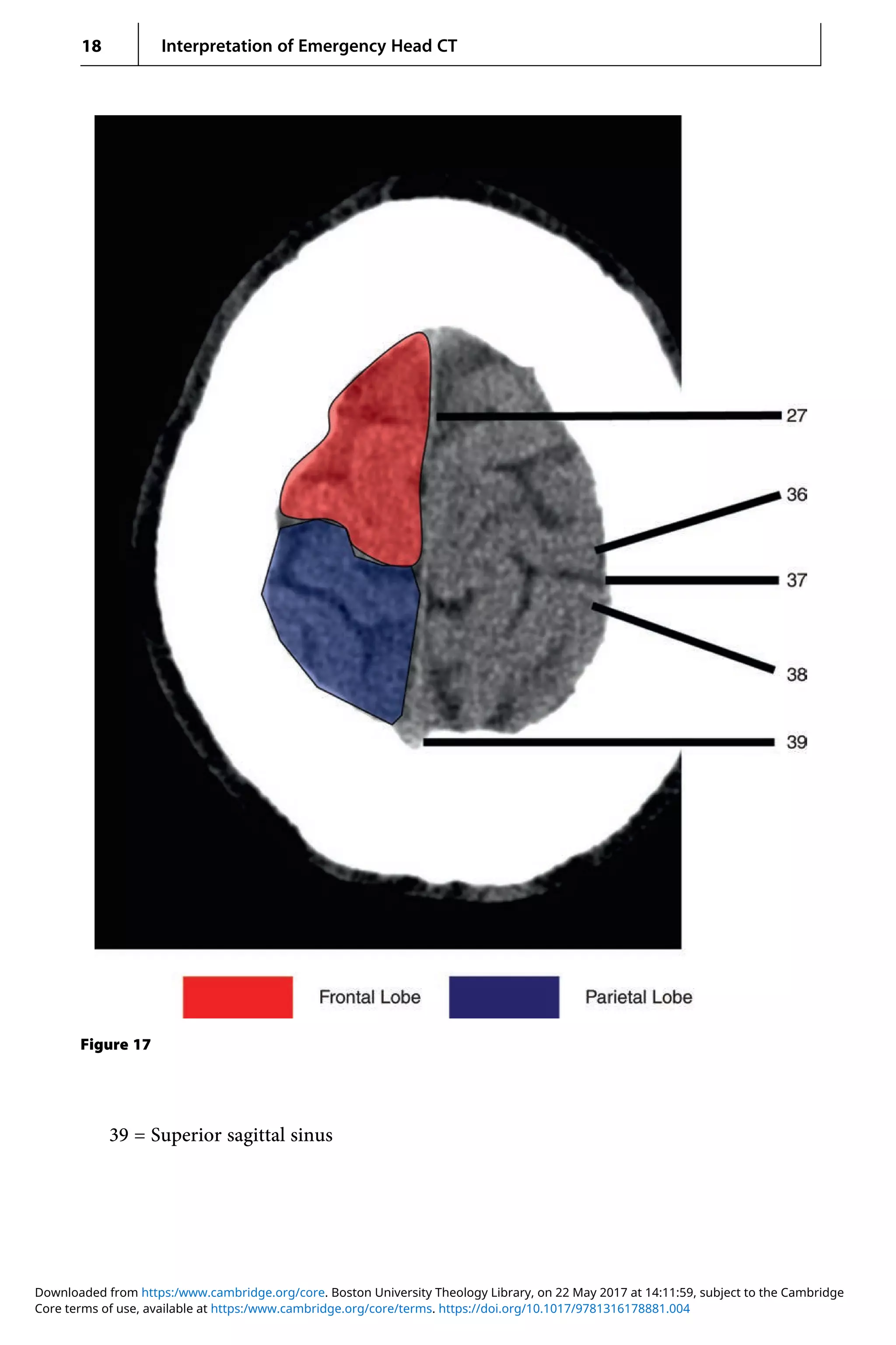 Interpretation of emergency head ct | PDF