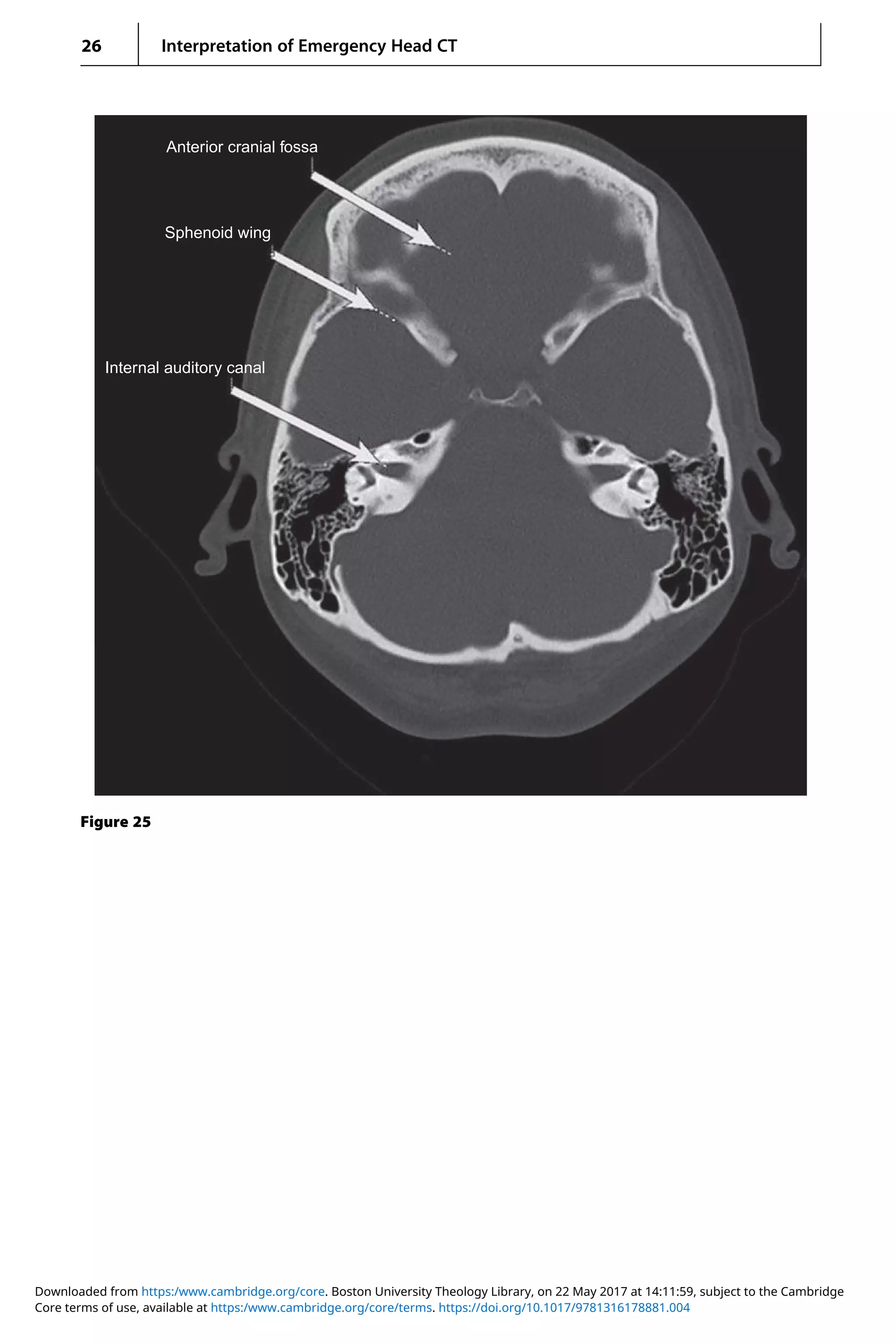 Interpretation of emergency head ct | PDF