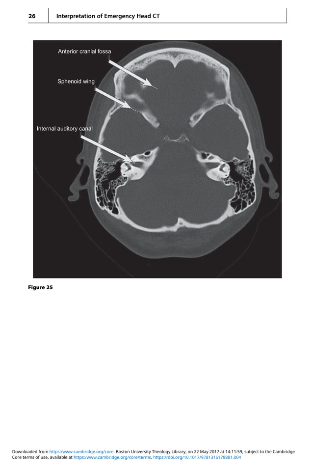 Interpretation of emergency head ct | PDF