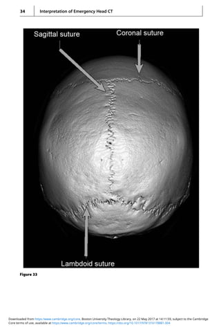 Interpretation of emergency head ct | PDF