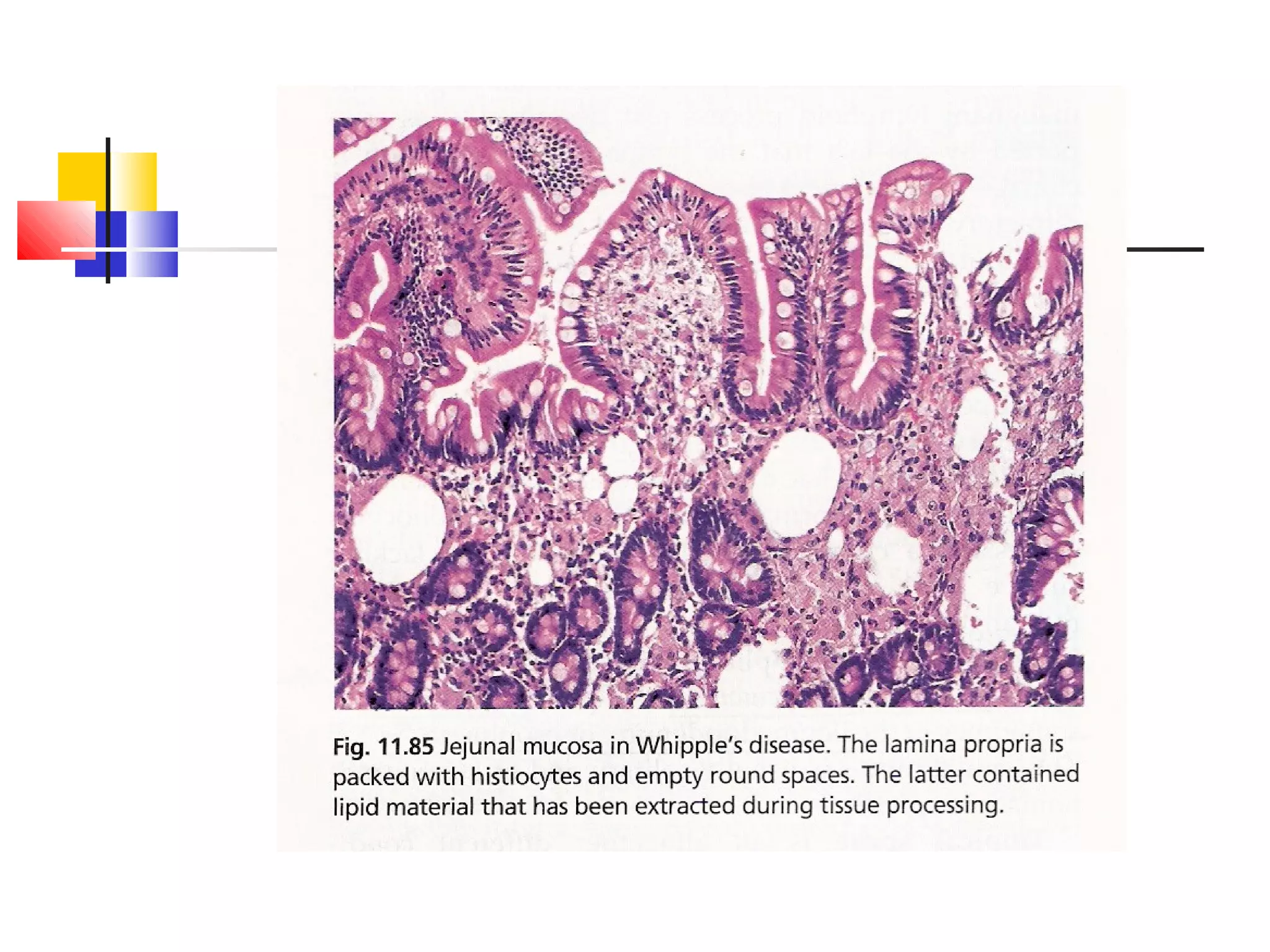 Interpretation of endoscopic intestinal biopsy | PPT