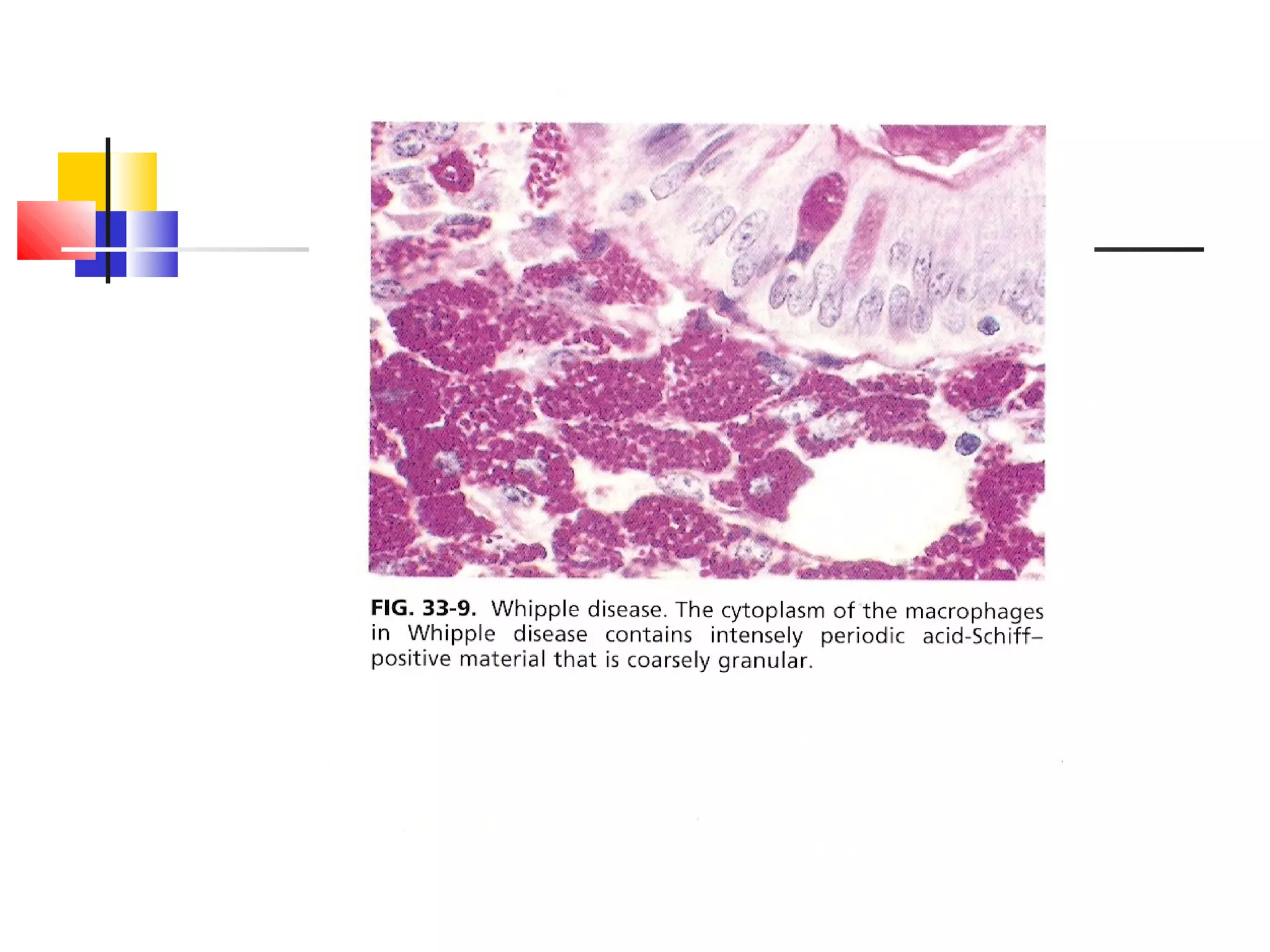 Interpretation of endoscopic intestinal biopsy | PPT