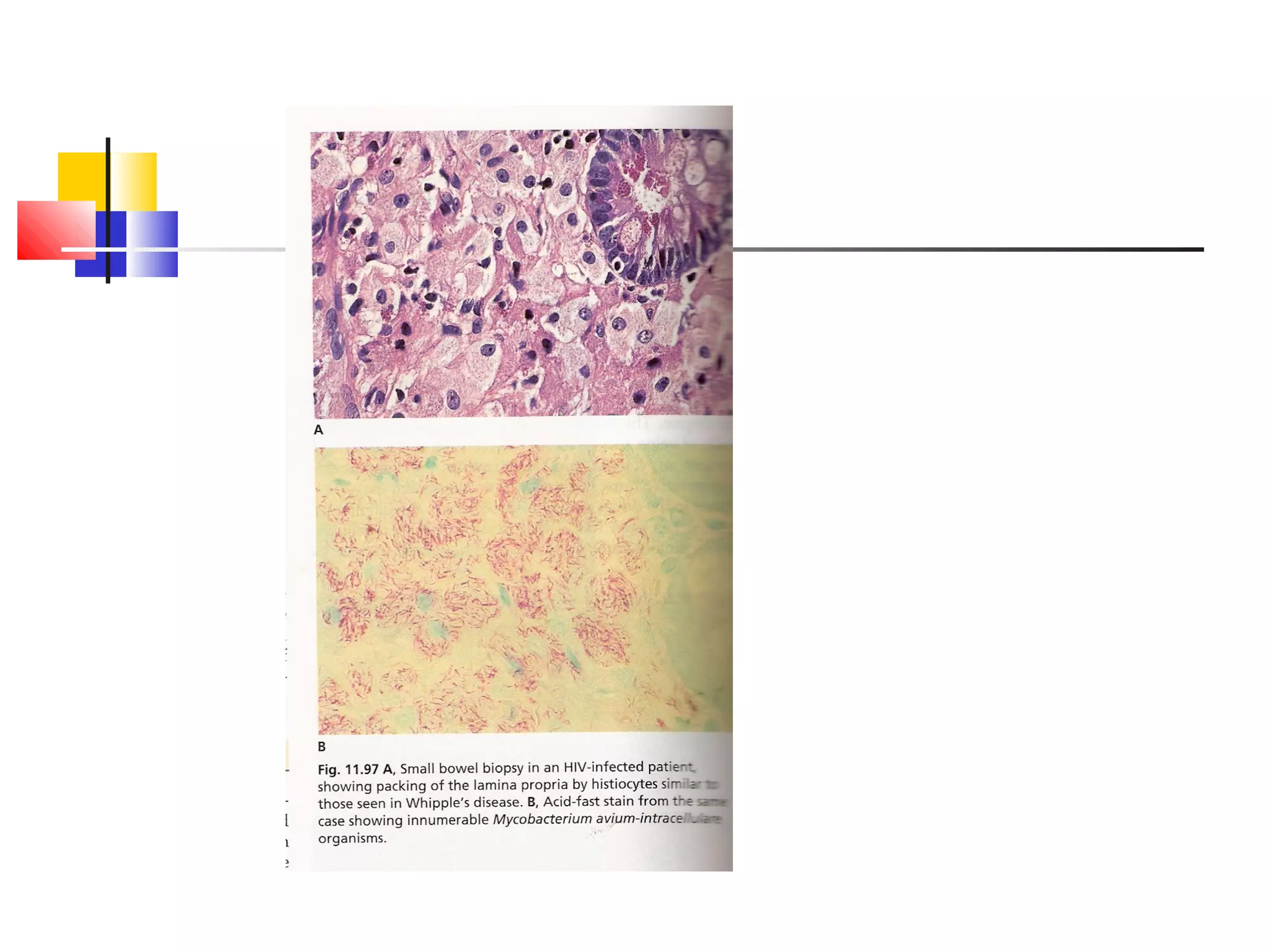 Interpretation of endoscopic intestinal biopsy | PPT