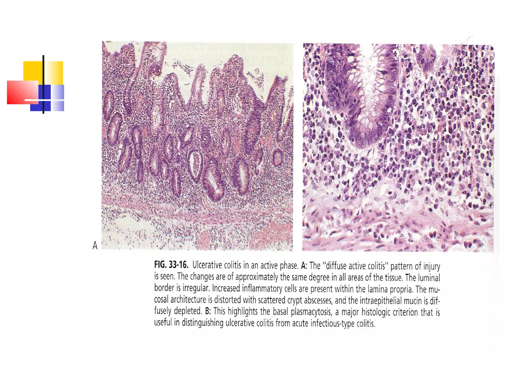 Interpretation of endoscopic intestinal biopsy | PPT