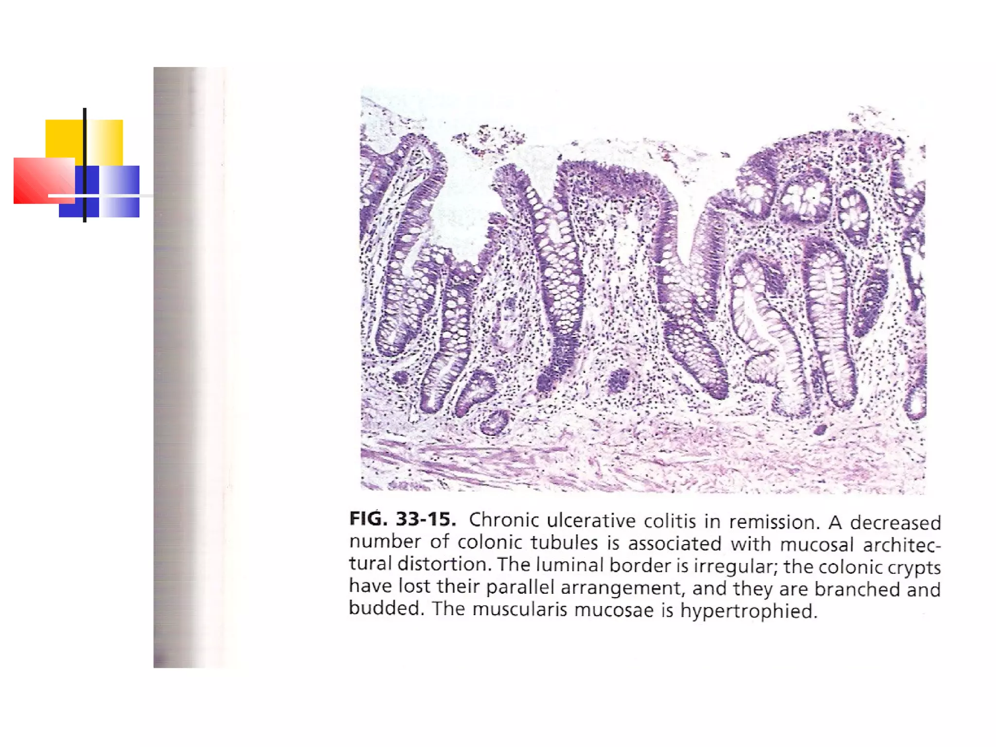 Interpretation of endoscopic intestinal biopsy | PPT