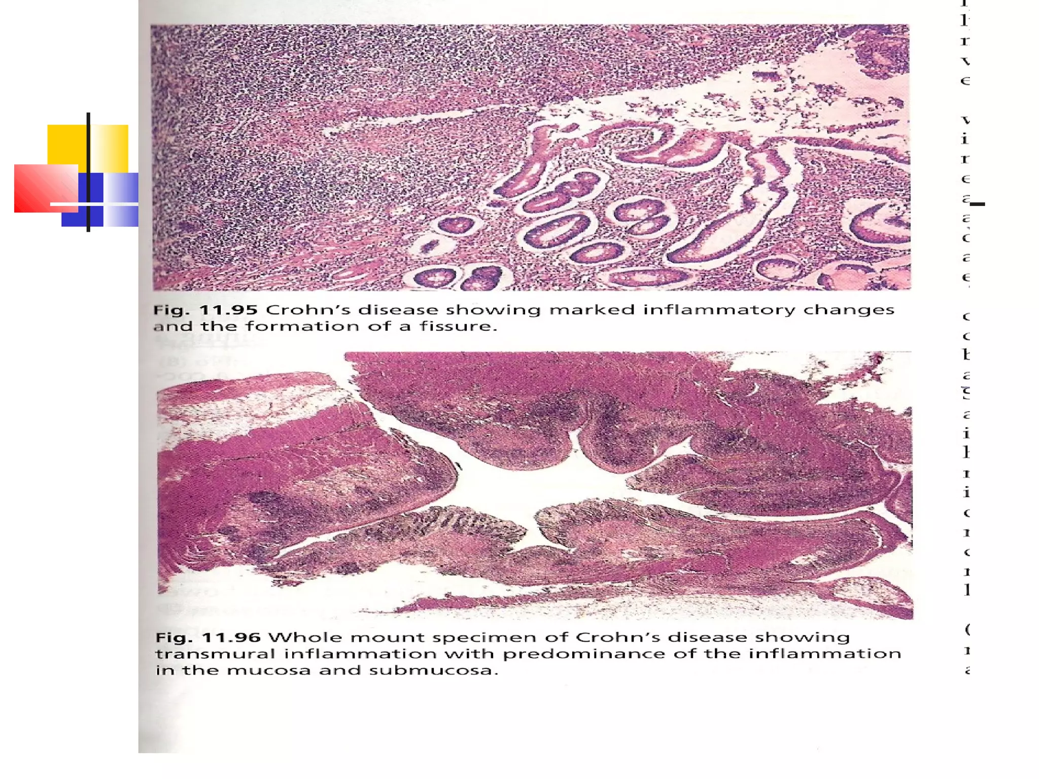 Interpretation of endoscopic intestinal biopsy | PPT