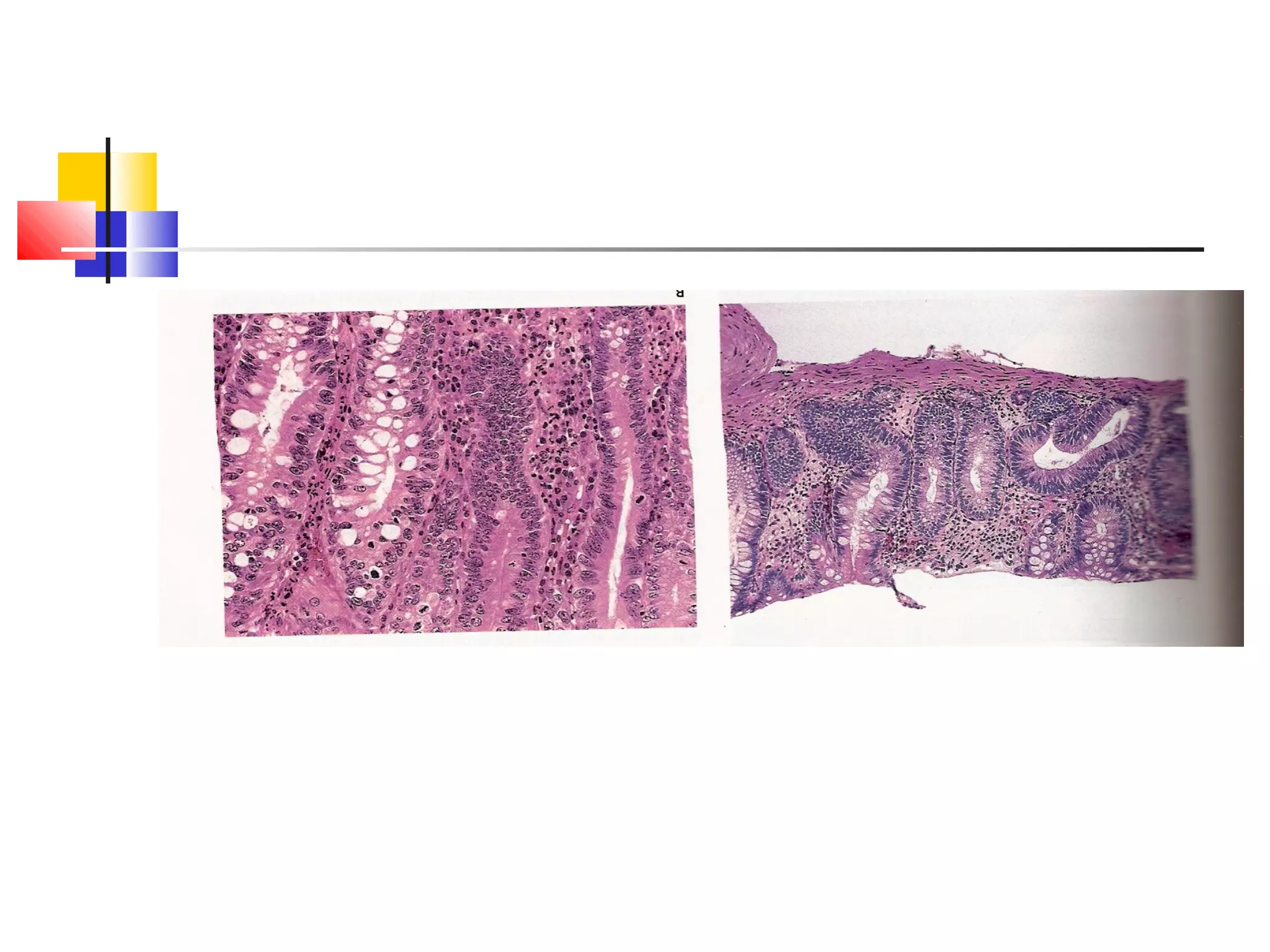 Interpretation of endoscopic intestinal biopsy | PPT
