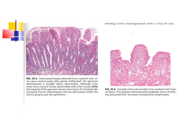 Interpretation of endoscopic intestinal biopsy | PPT | Digestive ...