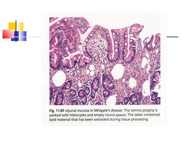 Interpretation of endoscopic intestinal biopsy | PPT | Digestive ...