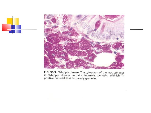 Interpretation of endoscopic intestinal biopsy | PPT | Digestive ...