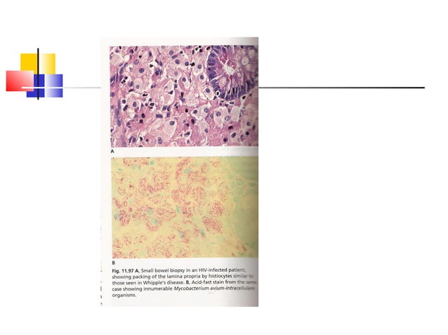 Interpretation of endoscopic intestinal biopsy | PPT | Digestive ...