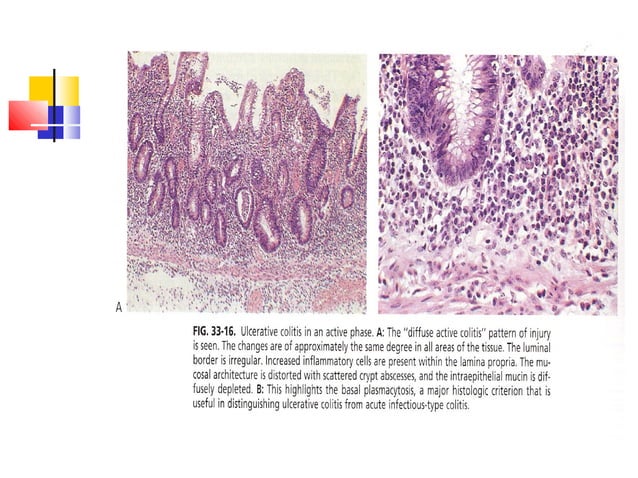 Interpretation of endoscopic intestinal biopsy | PPT | Digestive ...