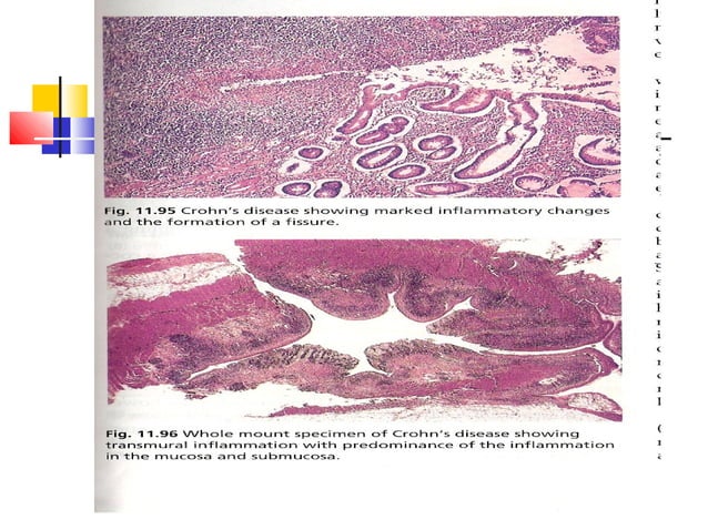 Interpretation of endoscopic intestinal biopsy | PPT | Digestive ...