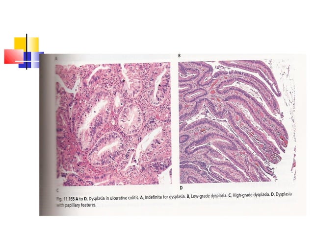 Interpretation of endoscopic intestinal biopsy | PPT | Digestive ...