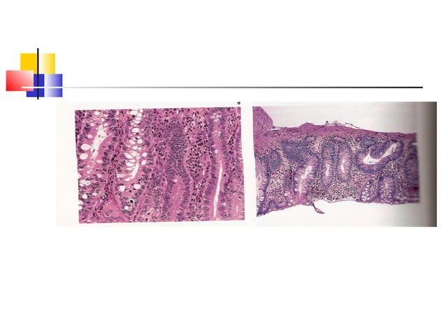 Interpretation of endoscopic intestinal biopsy | PPT | Digestive ...