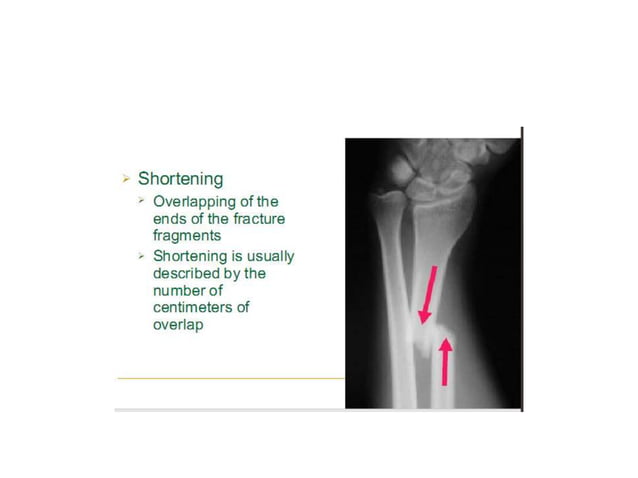 Interpretation of musculoskeletal x rays | PPTX