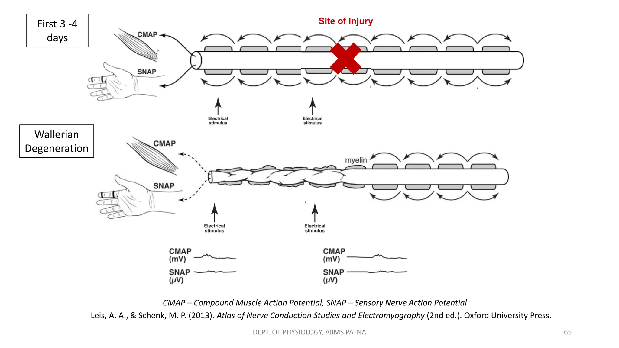 Interpretation of Nerve Conduction Study Findings | PDF