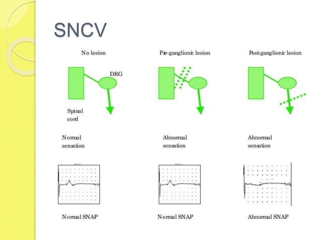 Interpretation of NCV.pptx | Brain and Nervous System Disorders ...