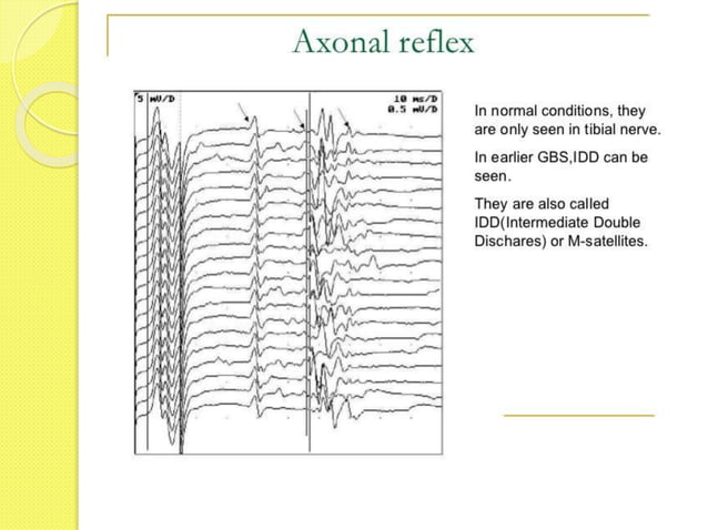 Interpretation of NCV.pptx | Brain and Nervous System Disorders ...