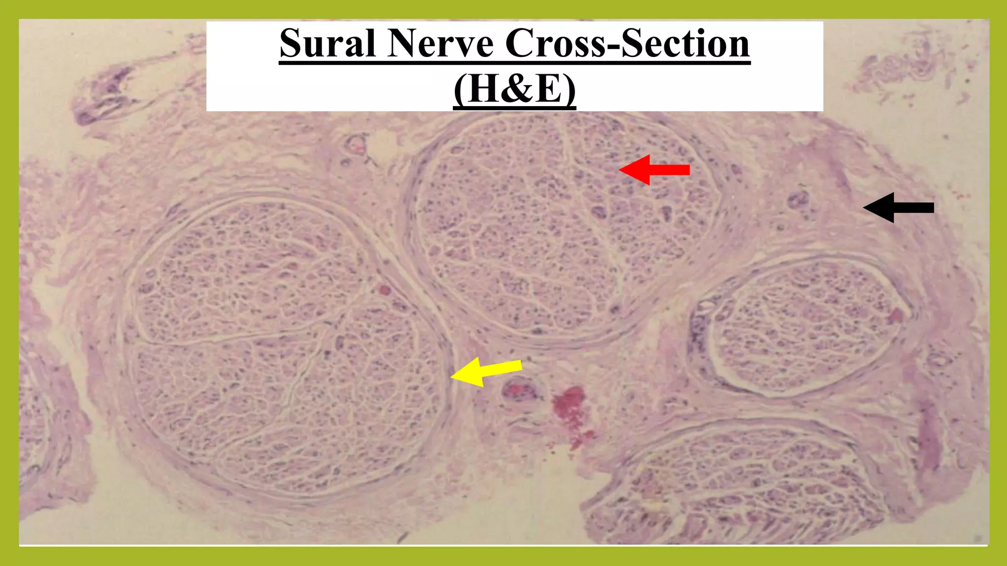 Interpretation Of Nerve Biopsy Pptx