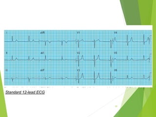 Interpretation of normal 12 leads electrocardiogram & some | PPTX