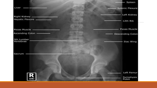 Interpretation of normal radiograph | PPTX | Death, Injury, or Military ...
